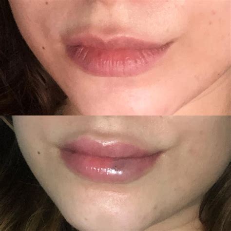 Juvederm Volift 💕 Scrolller