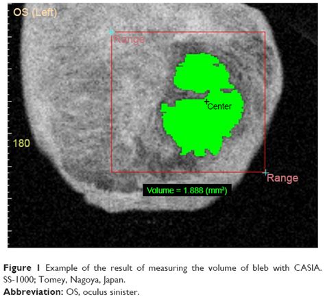 Factors Influencing The Filtration Bleb Volume After Ex Press® Sur Opth