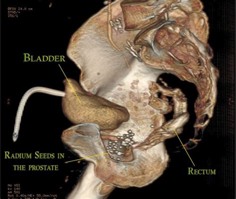 Bladder Urinary Fistula Maher A Abbas Md Proctology Colonoscopy