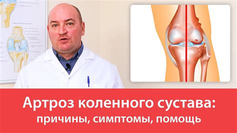 Артроз коленного сустава причины симптомы помощь Youtube