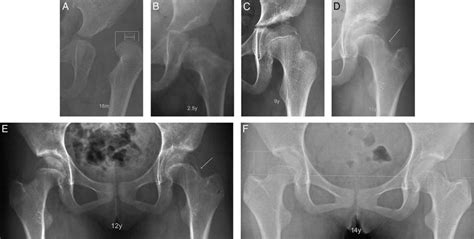 Type Ii Avascular Necrosis With Minimal Residue Deformity A