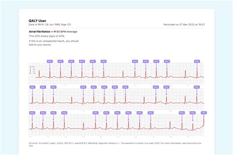 Ectopic Atrial Tachycardia