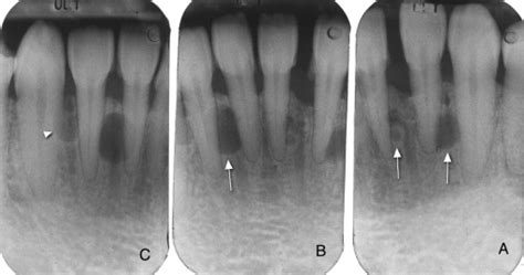 Multifocal Lateral Periodontal Cysts A Report Of 4 Cases And Review Of