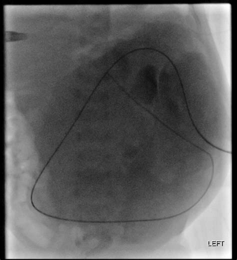 A Percutaneous Drain Was Placed To Decompress The Lesion Due To The Download Scientific