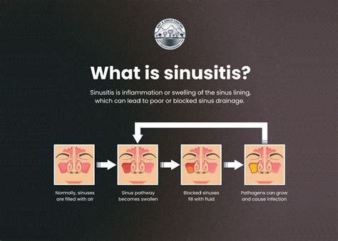 What Is Sinusitis Ent And Sinus Center