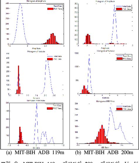 Figure 1 From Pvc Detection Based On The Distortion Of Qrs Complex On Ecg Signal Semantic Scholar