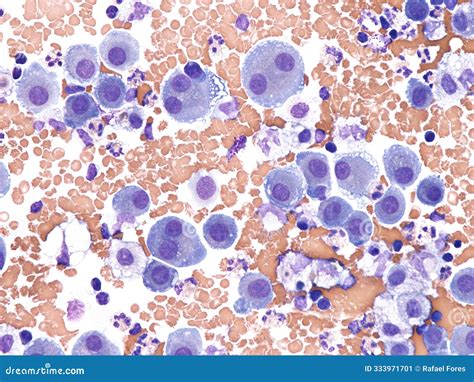 Mesothelial Cells In Pleural Fluid Stock Image Image Of Mesothelial