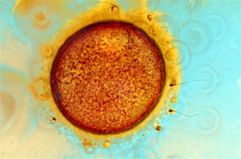 Does The Wrong Sperm Mean Wrongful Birth The Brian Lehrer Show Wnyc