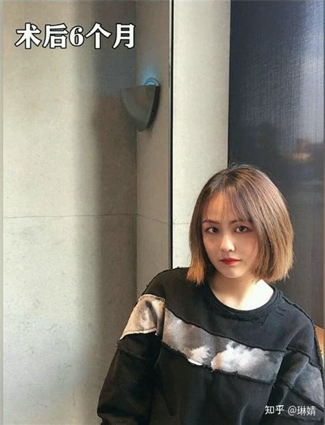如何辨别更适合耳软骨鼻 Or 肋骨鼻？ 知乎