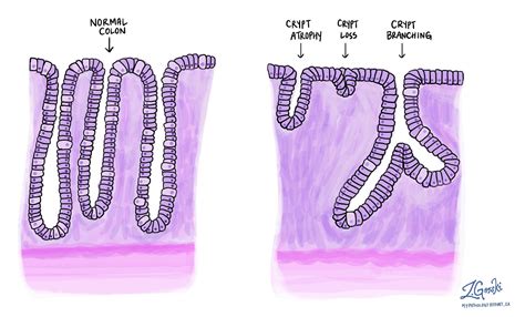 Chronic Colitis Mypathologyreportca