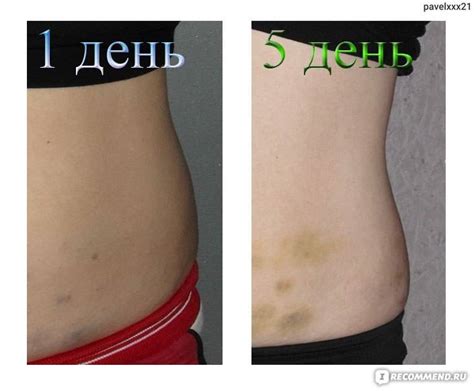 Липолитики для живота. Отзывы, результаты фото до и после похудения