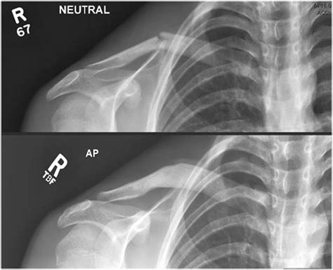 Clavicle Fractures Fracture Healing