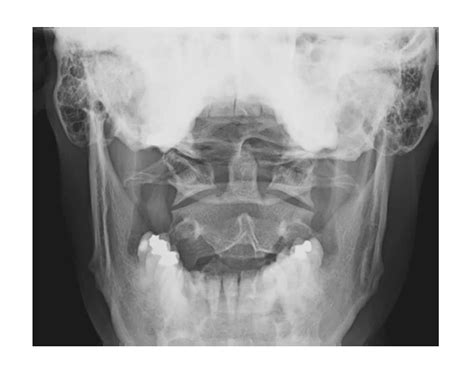 Ap Open Mouth Odontoid View Quiz
