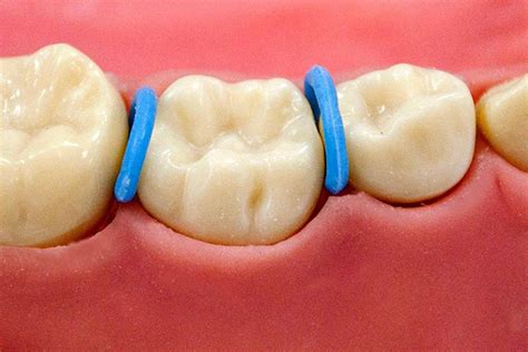 Separators Brilliant Orthodontics Orthodontic Elastic Supplier