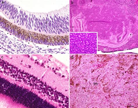 A Section Through The Eye Of An 8 Week Human Embryo A Retinoblastoma