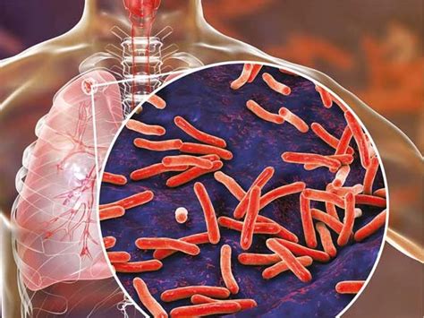 Symptoms Of Tuberculosis Diagnosis And Precautions Linkscut1