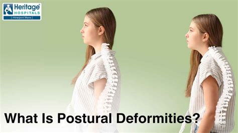 What Is Postural Deformities Causes Effects And Prevention Tips