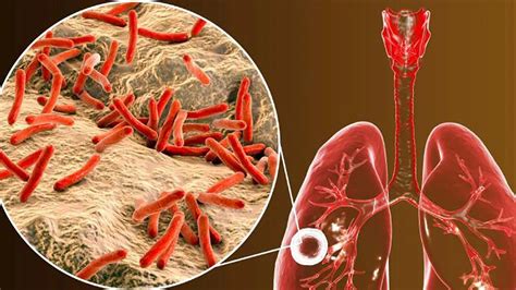 Prevención De La Tuberculosis