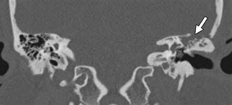 Ct Of Skull Base Fractures Classification Systems Complications And Management Radiographics