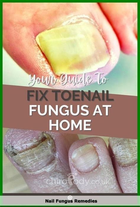 Kill Toenail Fungus At Home Artofit