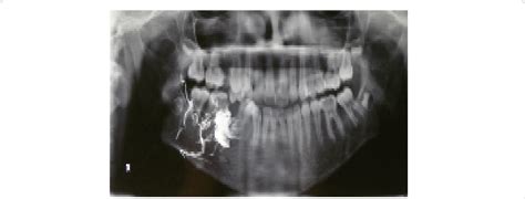 Radiographic Control After Embolization With Onyx Download