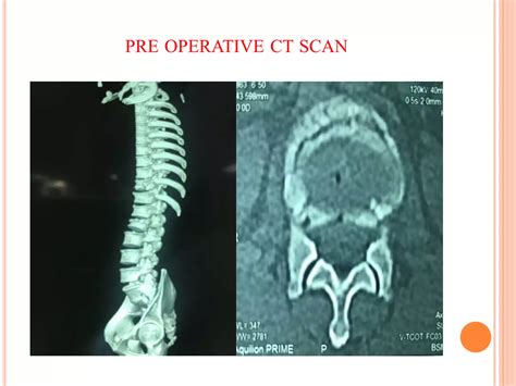 Thoracolumbar Burst Fractures Pptx