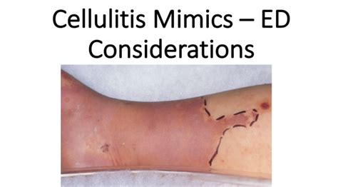 Cellulitis Mimics Ed Considerations Emdocs