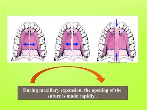 How To Measure Cbct Before And After Mid Palatal Suture Opening Ppt