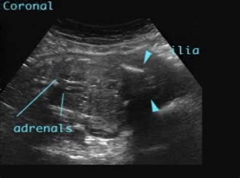 Bilateral Renal Agenesis Ultrasoundpaedia