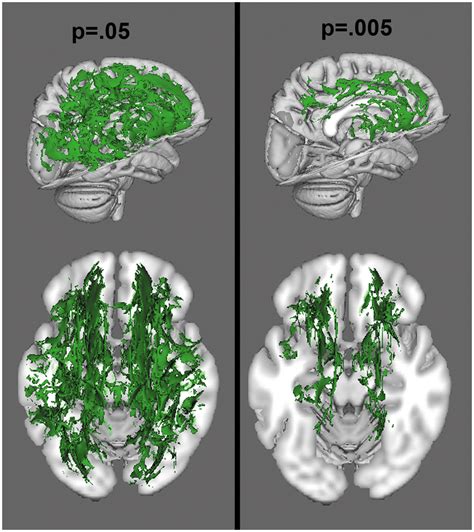 Voxelwise Analysis Of Radial Diffusion At A Threshold Of P Green