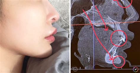 Popular Model S Shocking Face X Rays Expose Horrors Of Plastic Surgery Koreaboo