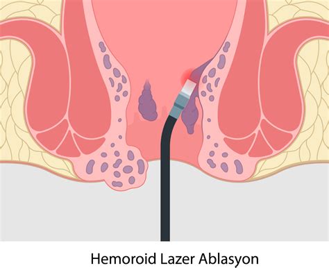 Hemoroid Basur