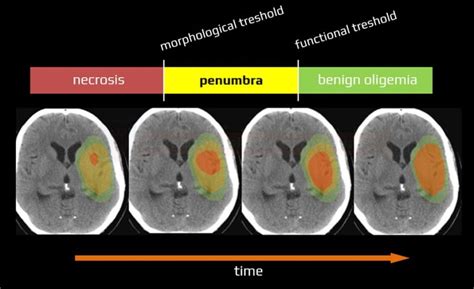 Ischemic Penumbra Stroke Manual