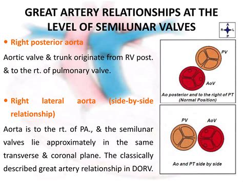 Double Outlet Right Ventricle Ppt