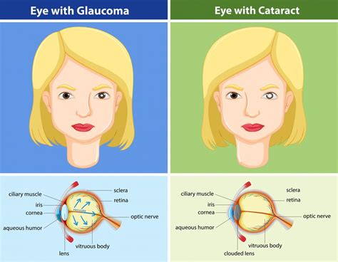 Understanding Glaucoma Types Risk Factors And Treatment Options