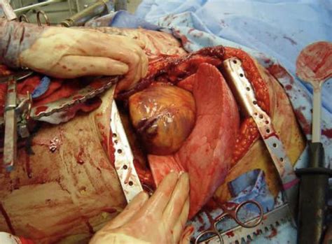 Emergency Resuscitative Thoracotomy Rnsfl