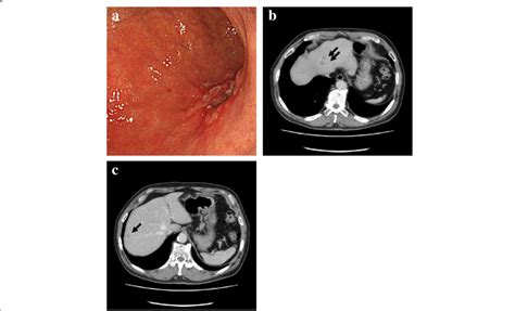Gastrointestinal Endoscopy And Computed Tomography Findings At The Time
