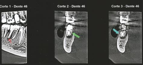 Instala O De Implante Imediato Regenera O Ssea Guiada Ap S