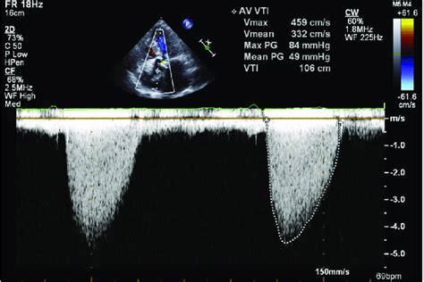 Continuous Wave Doppler On Tte In The Apical Five Chamber View Showing