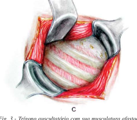 Figure 2 From Minimally Invasive Thoracotomy Muscle Sparing