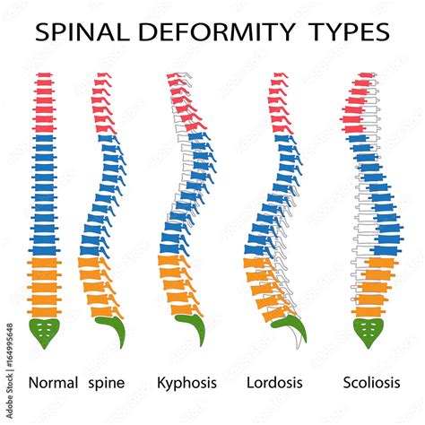 Poster Spinal Deformity Types Wall Art Ukposters