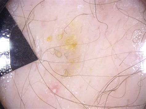 Examples Of Skin Lesion Images On The Isic2019 And Pad20 Datasets Download Scientific Diagram