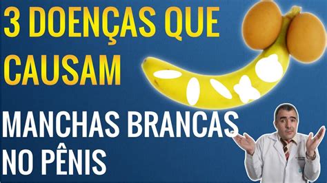 Descubra as 3 doenças que podem causar manchas brancas no pênis