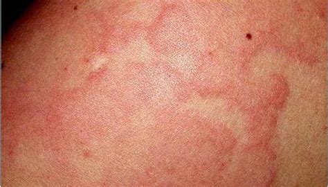 Urticaria En La Piel Por Qué Aparece Y Cómo Puedes Curarla Salud