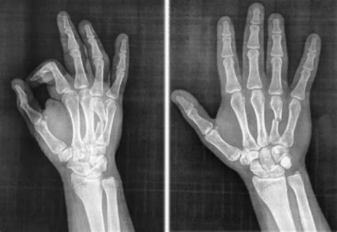 A Preoperative X Ray Ap And Oblique View Showing Transverse