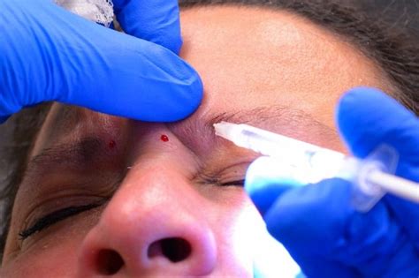 How Much Is Botox The Complete Guide