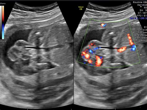 Umbilical Hernia In Adults Ultrasound Congenital Hernia Of Cord An