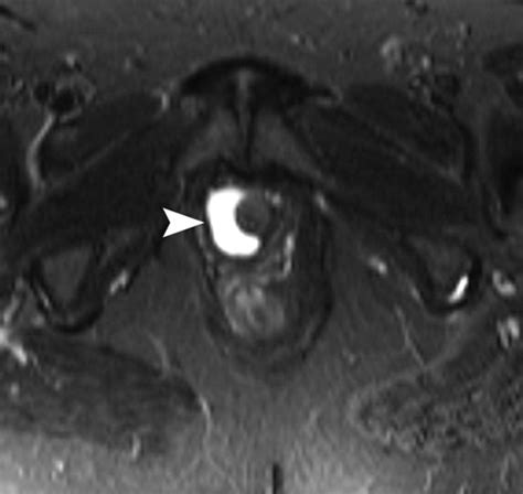 Mr Imaging And Us Of Female Urethral And Periurethral Disease