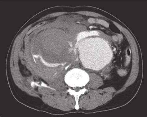 Preoperative Contrast Enhanced Computed Tomography Of Ruptured