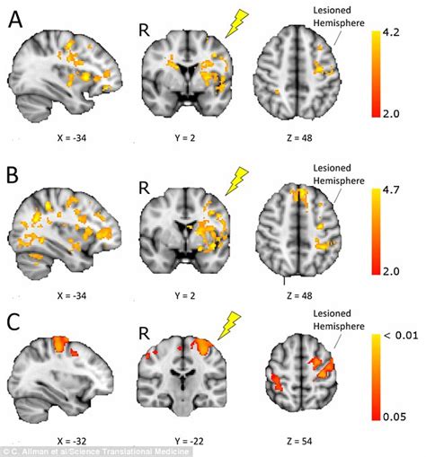 Zapping The Brains Of Stroke Patients With Electricity Can Restore Strength And Grip Daily
